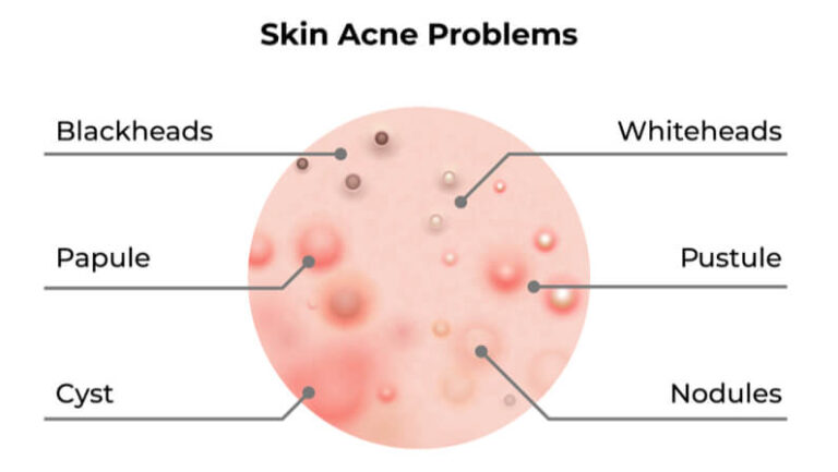 What Causes Forehead Acne and Crucial Things to Know - Team Dermatology