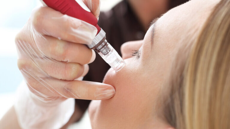 How to get rid of ice pick scars? - Team Dermatology