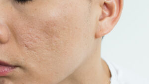 How to get rid of ice pick scars? - Team Dermatology