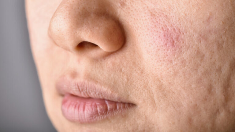What are Pockmarks? Causes, Treatment, Prevention Tips - Team Dermatology