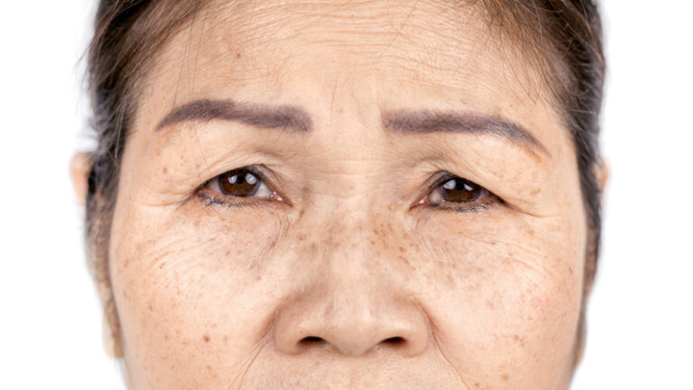When To Seek Treatment For Sagging Eyelids | Team Dermatology
