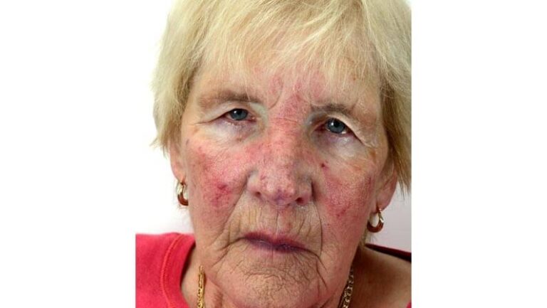 Facial Redness: Causes, Symptoms and Treatments - Team Dermatology