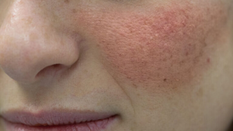 Facial Redness: Causes, Symptoms and Treatments - Team Dermatology