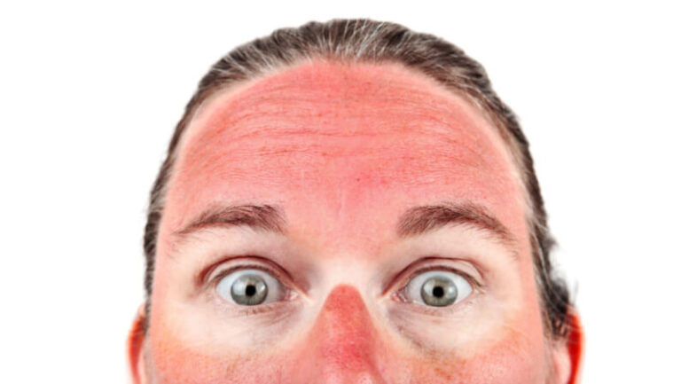 Facial Redness: Causes, Symptoms and Treatments - Team Dermatology