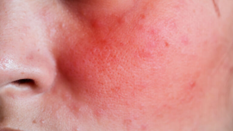 Facial Redness: Causes, Symptoms and Treatments - Team Dermatology