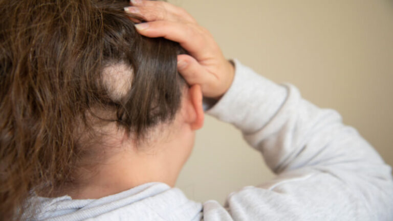 How to Prevent Hair Loss & Find the Right Solution