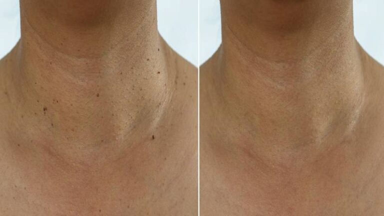 Are Skin Tags Common In Pregnancy? | Team Dermatology